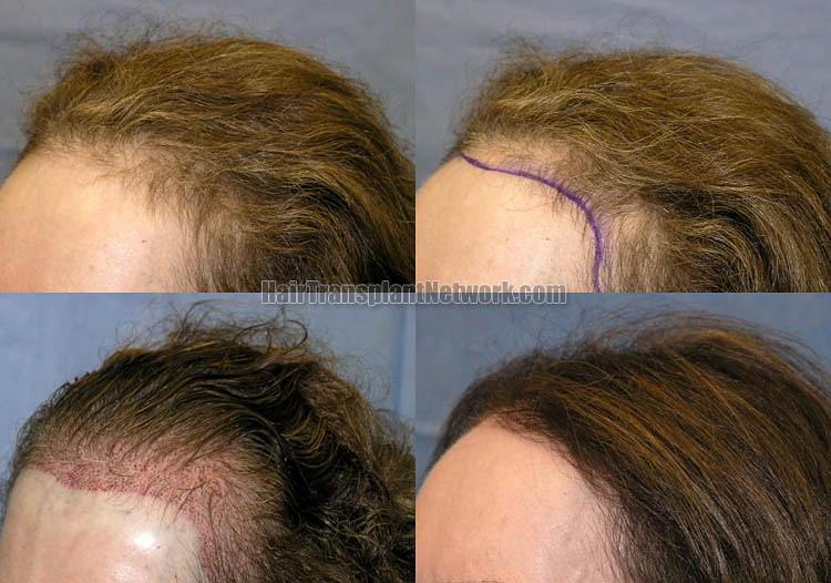 Dr. Robert M. Bernstein Female Hair Transplant patient Ludwig Class 2 ...