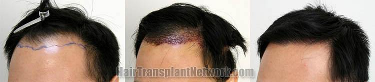 Dr. Robert True Hair transplant surgery to the hair line before and ...