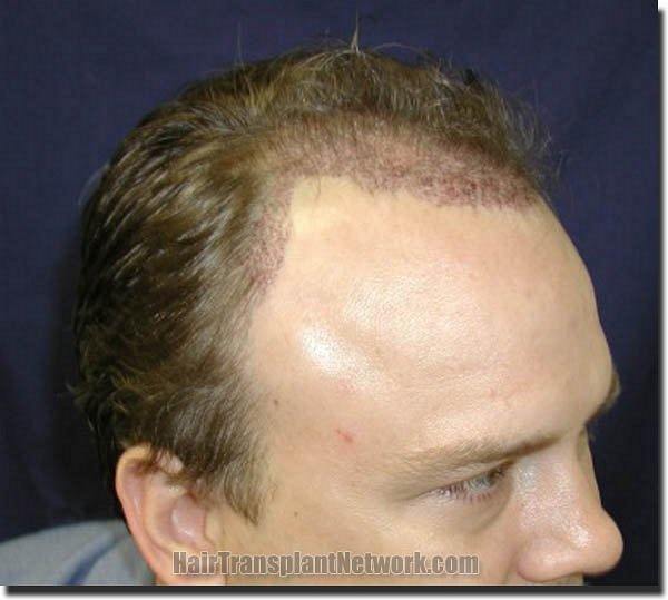 Dr. Glenn Charles Hair transplant surgery before and after photos