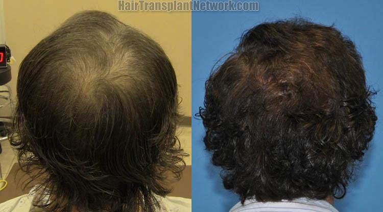 Dr. Mike Vories Hair restoration surgery before and after result images ...