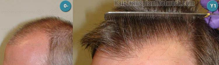 Dr. Jean Devroye Hair transplant surgery before and after images with ...