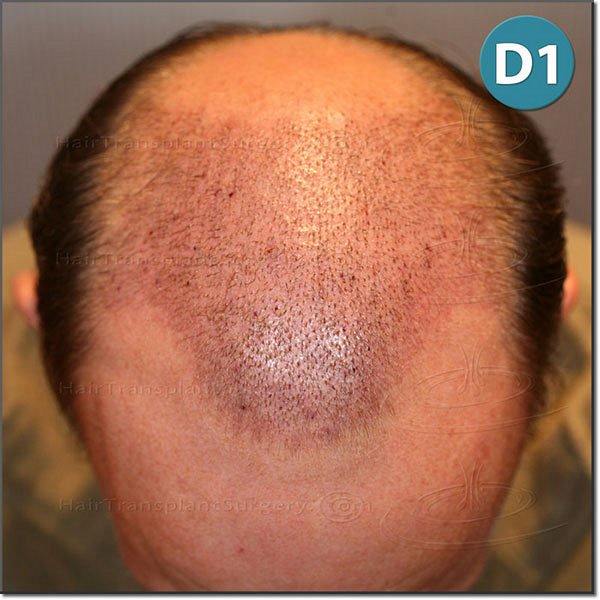 Dr. Jean Devroye Hair transplant surgery before and after photos