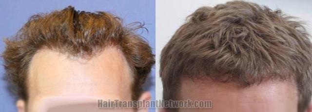 Dr Timothy Carman Hair Restoration Surgical Procedure Before And After