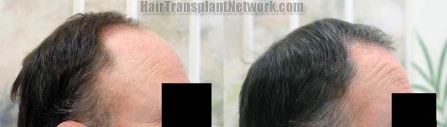 Dr Timothy Carman Hair Restoration Surgical Procedure Before And After
