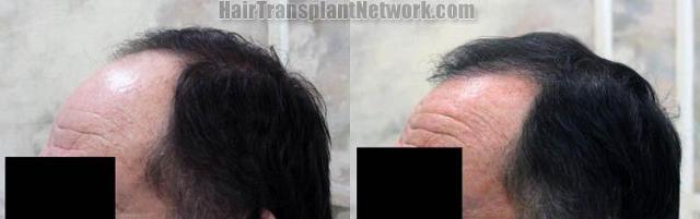 Dr Timothy Carman Hair Restoration Surgical Procedure Before And After