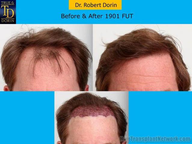 Dr. Robert Dorin Hair transplant surgical procedure before and after ...