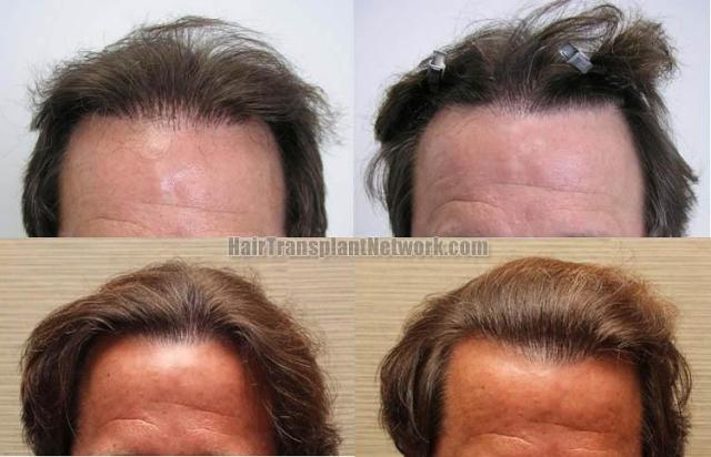 Dr. Robert True Hair transplant surgery repair procedure to correct old ...