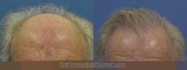 Dr Timothy Carman Hair Transplant Procedure Before And After Result