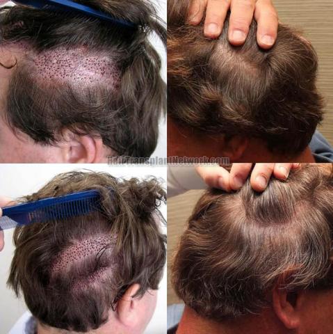 Dr. Robert True Hair transplant surgery repair procedure to correct old ...