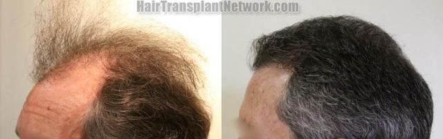 Dr Timothy Carman Hair Transplant Before And After Photos From 3099