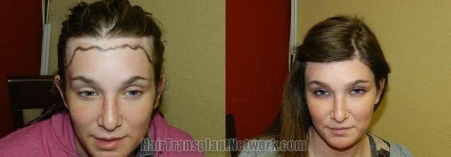 Dr. John Diep Transgender hair transplant surgery before and after ...